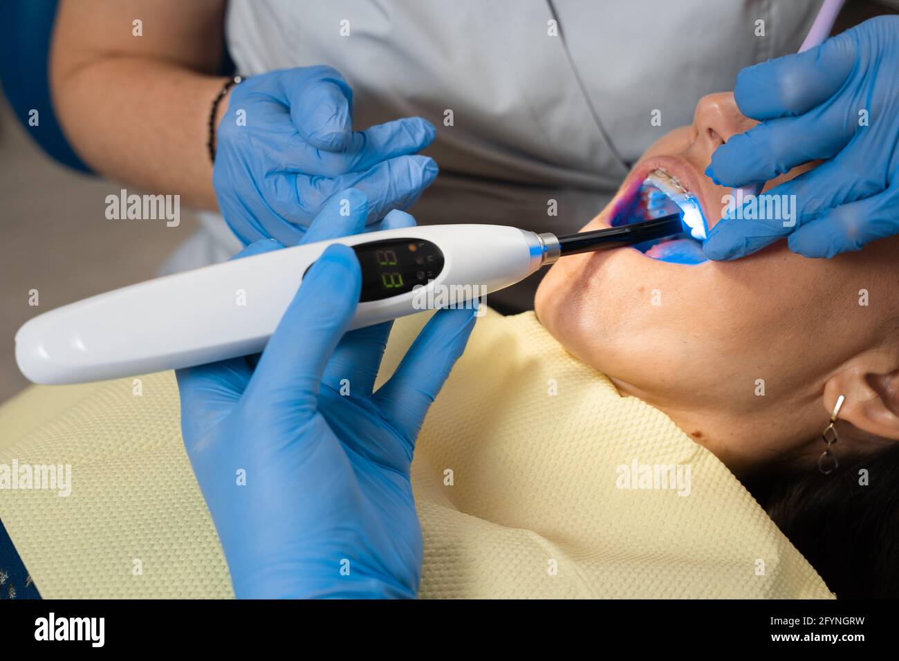 UV illumination of photopolymer tooth filling. Dentist treats and ...