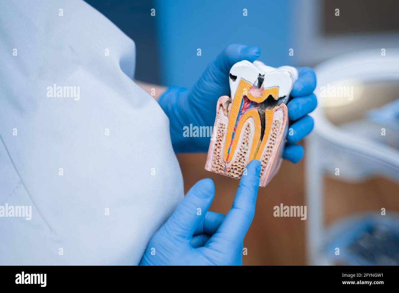 Dummy of a sick tooth with caries, Dentist shows structure of the teeth ...