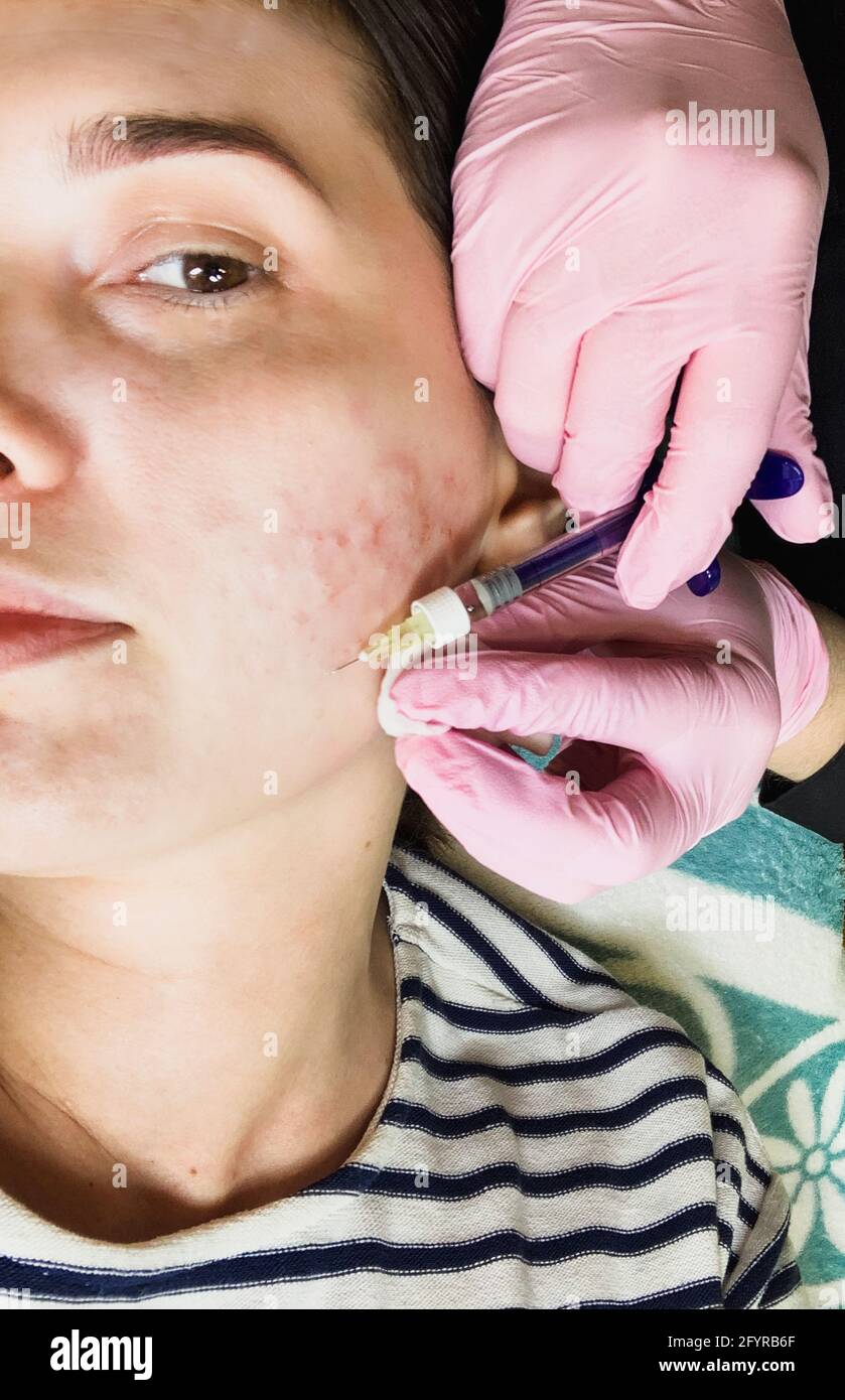 hands close-up make injections in the face Stock Photo - Alamy