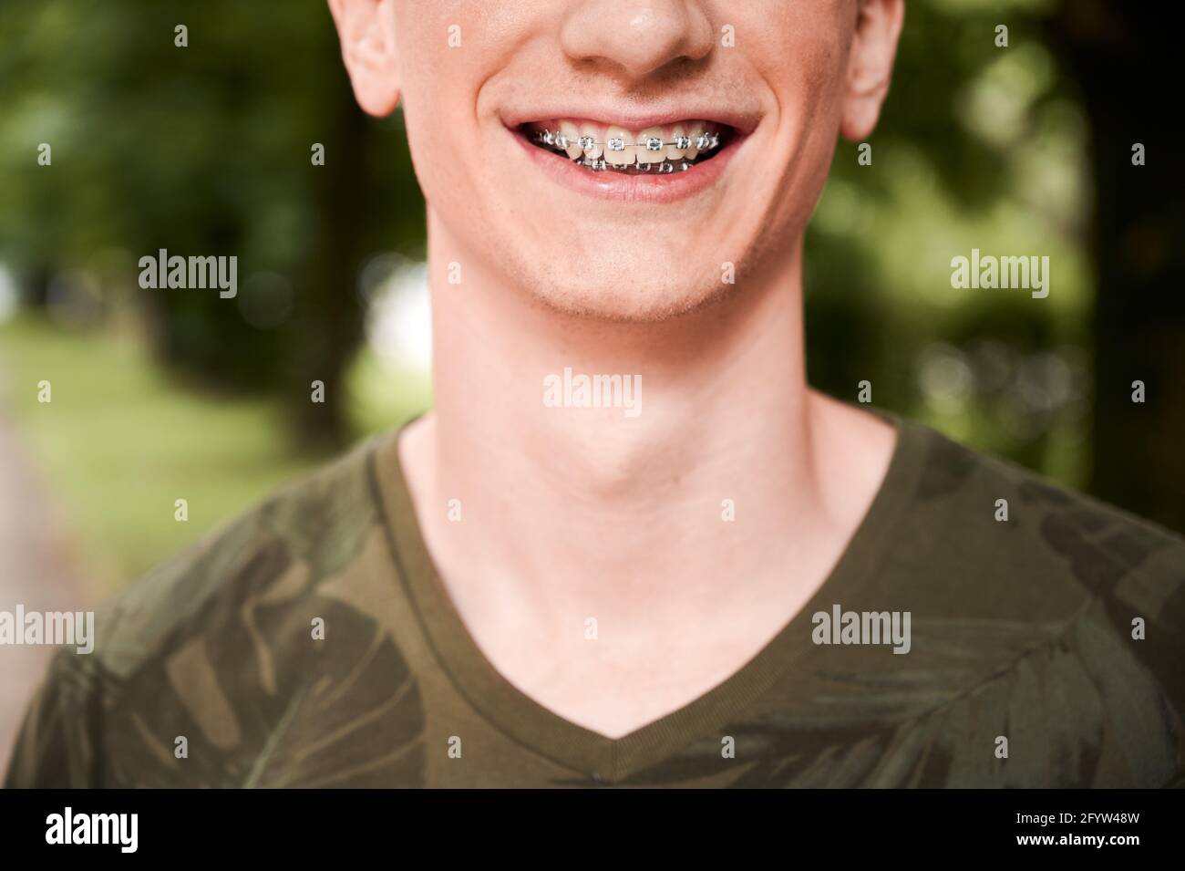 Close up of cheerful man with orthodontic brackets on teeth standing on ...