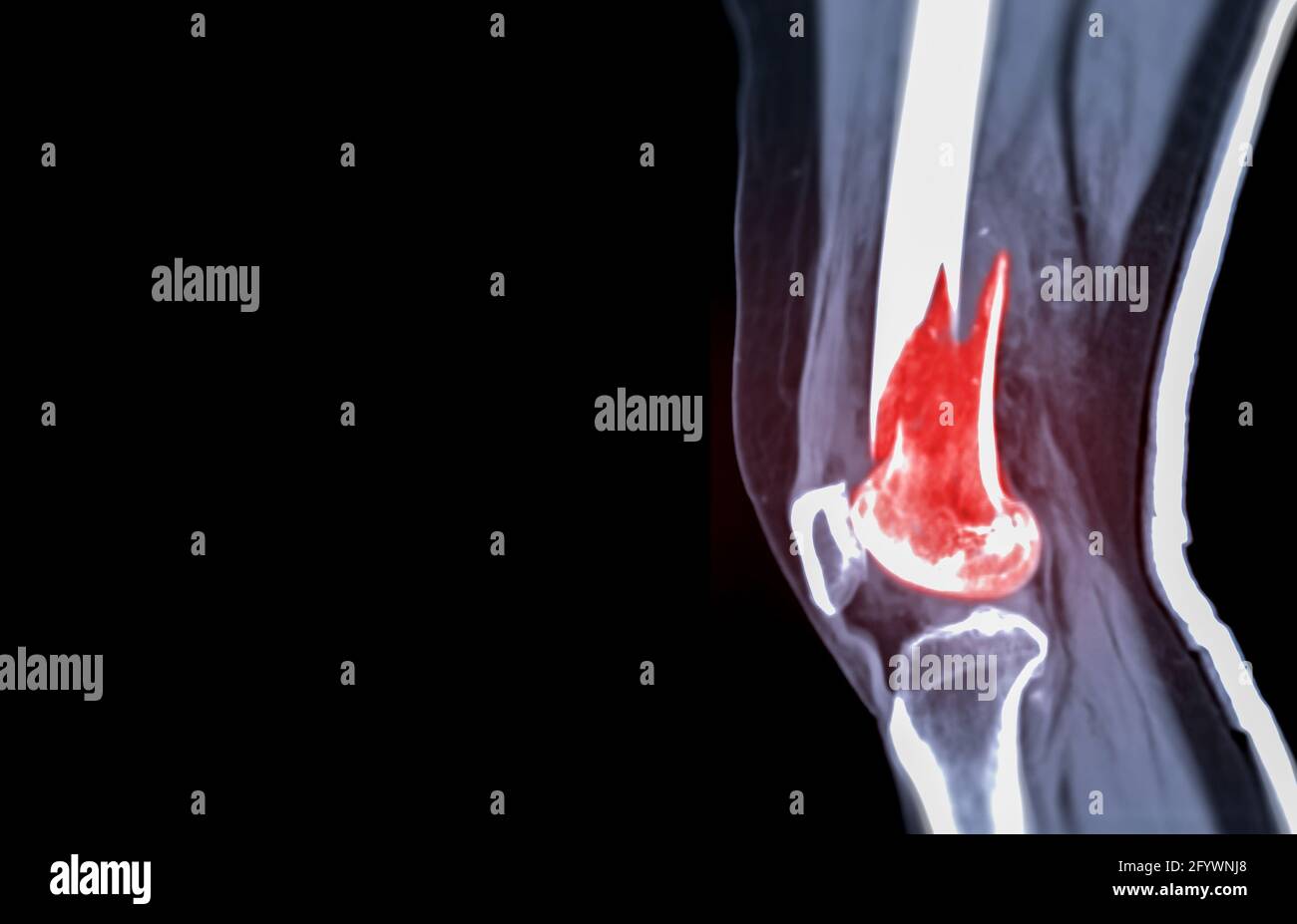 CT knee 3D rendering image Lateral view isolated on black background ...