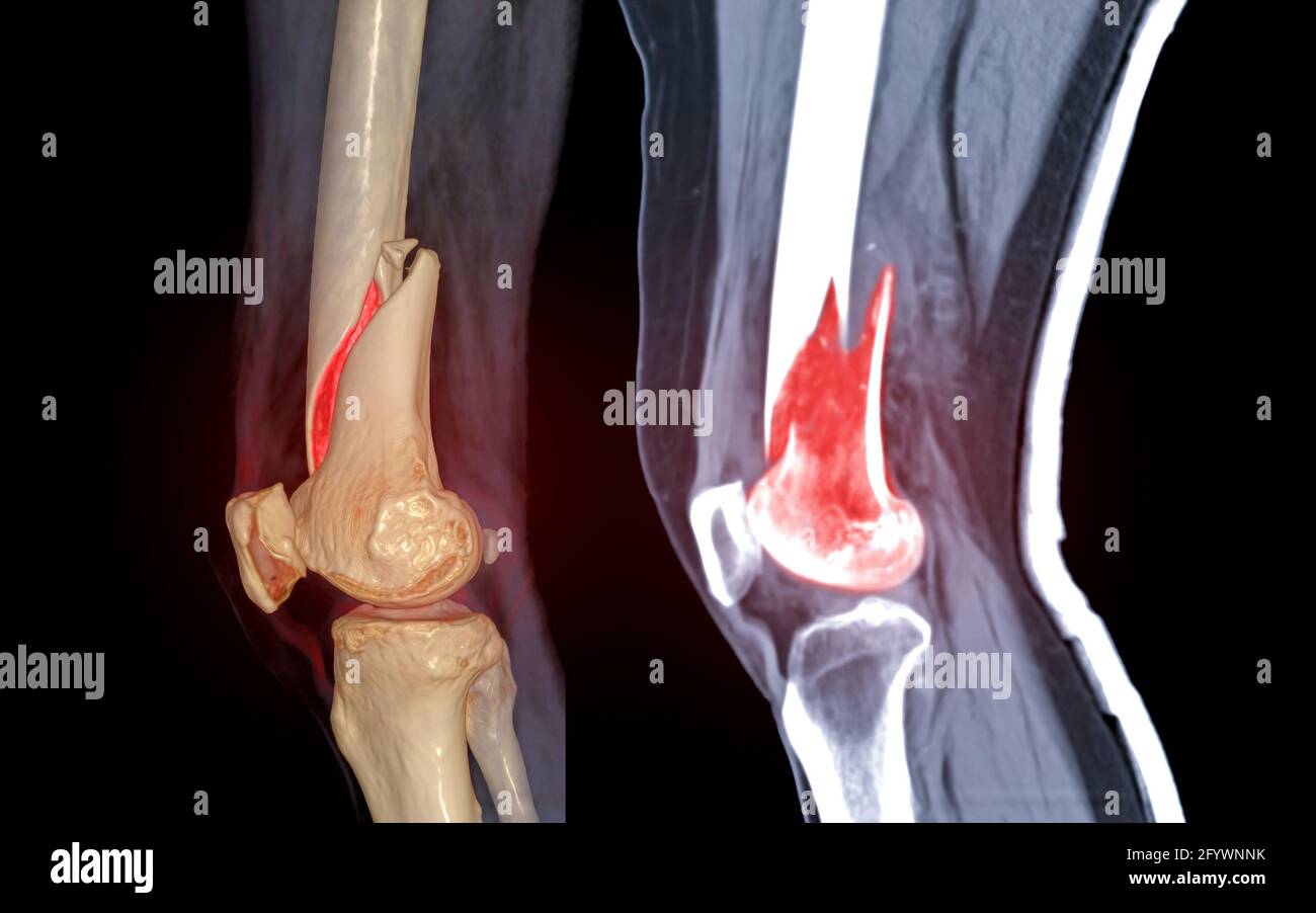 CT knee joint 3D rendering image lateral view and Sagittal view ...
