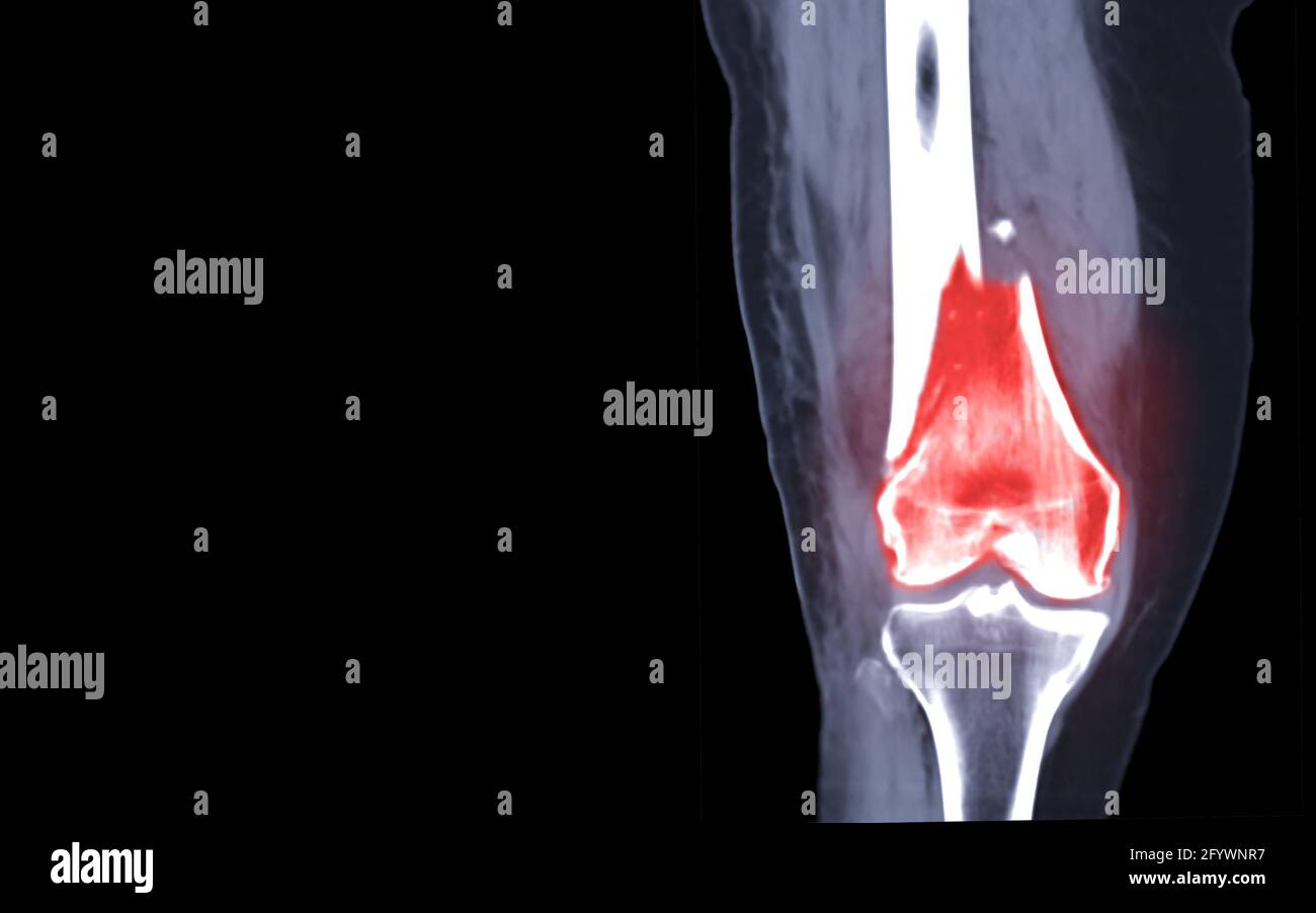 CT knee joint Coronal view isolated on black background showing ...