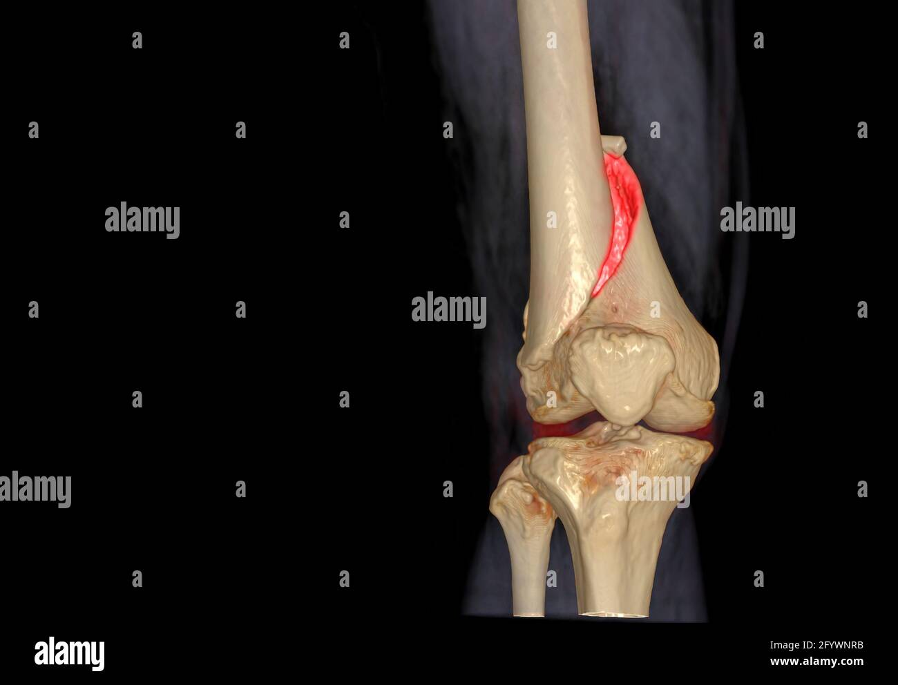 CT knee 3D rendering image AP view isolated on black background showing ...