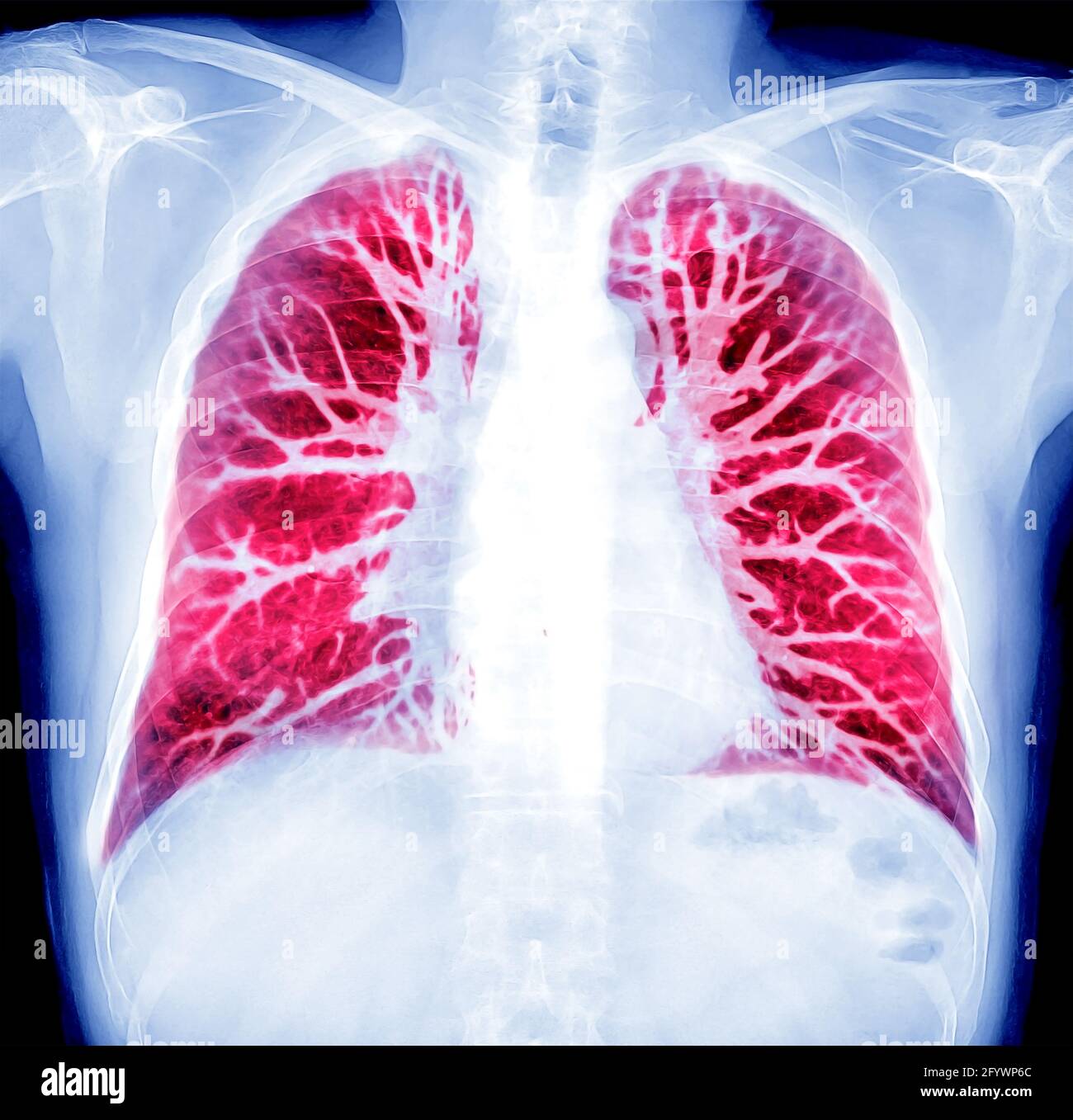 Oil paint effect of Chest X-ray or X-Ray Image and CT Chest Lung preset ...