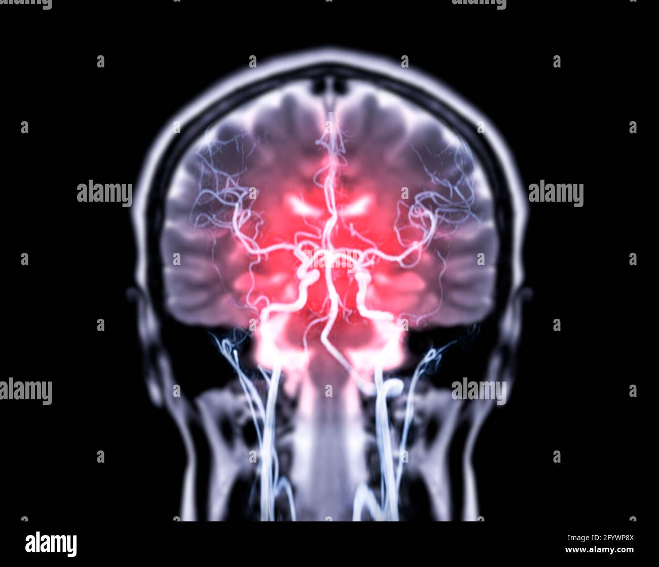 MRI brain Coronal T2W and MRA Brain fusion in Coronal view Stock Photo ...