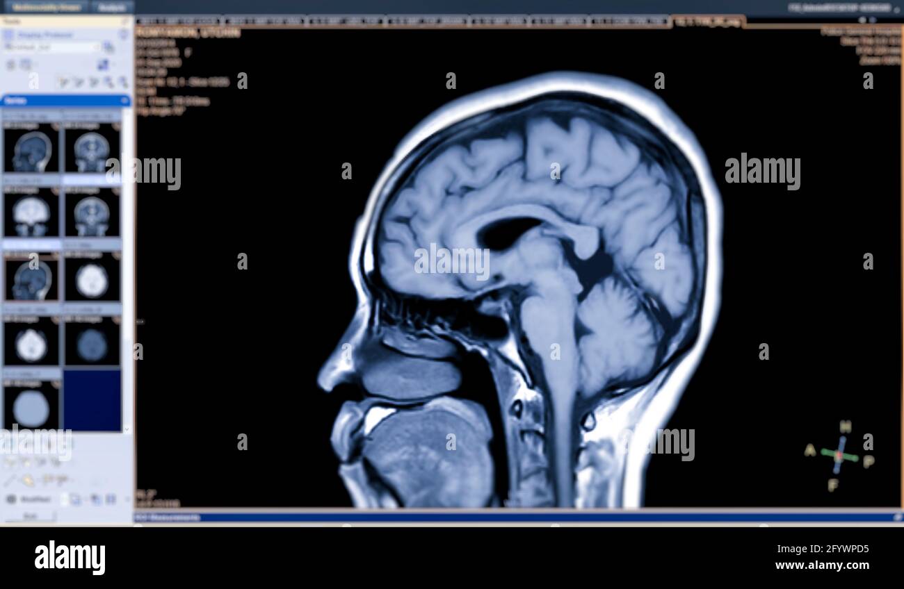MRI Brain sagittal T1 view for detect a variety of conditions of the brain such as cysts, tumors ...