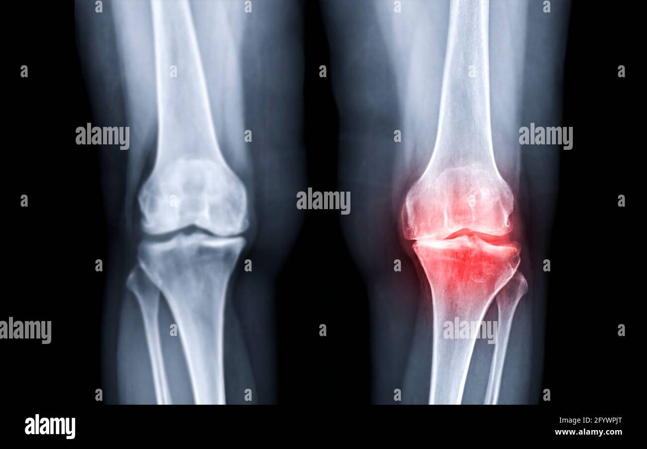 Selective focus of x-ray image of both knee AP view for diagnostic ...