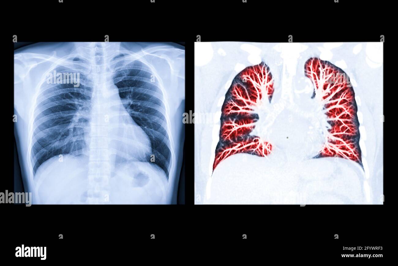 Chest X Ray Tb Vs Normal