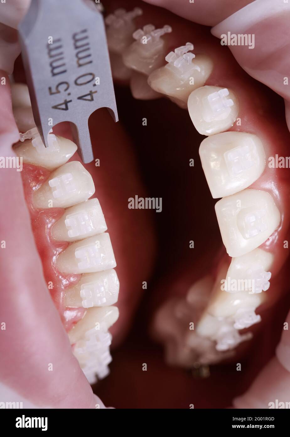 Close up of orthodontist using aluminum bracket gauge while attaching ...