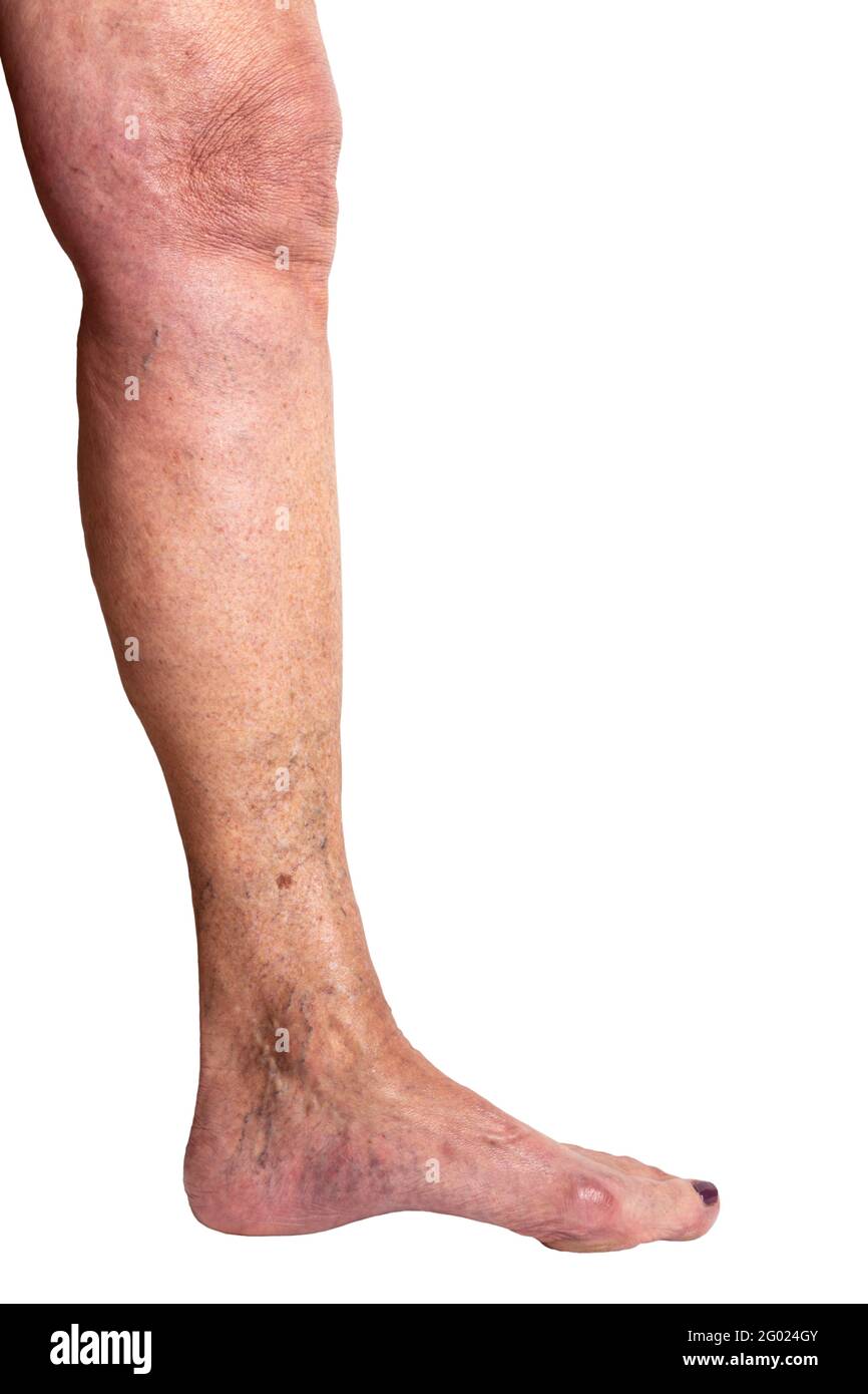 Leg of an elderly Caucasian woman with spider veins and varicose veins ...