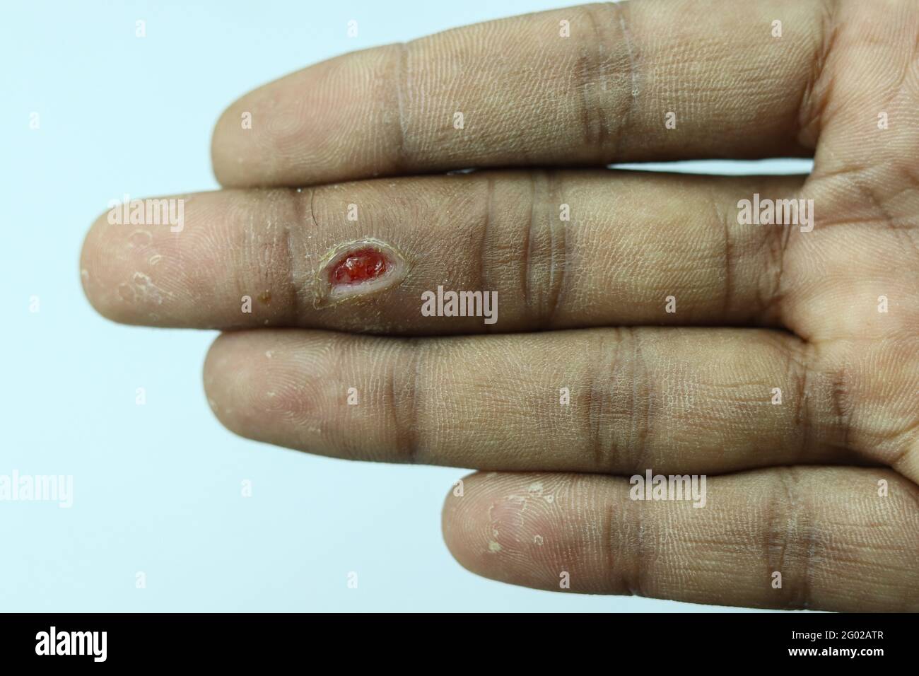 Closeup shot of a wound after removing a wart on a finger of a man ...