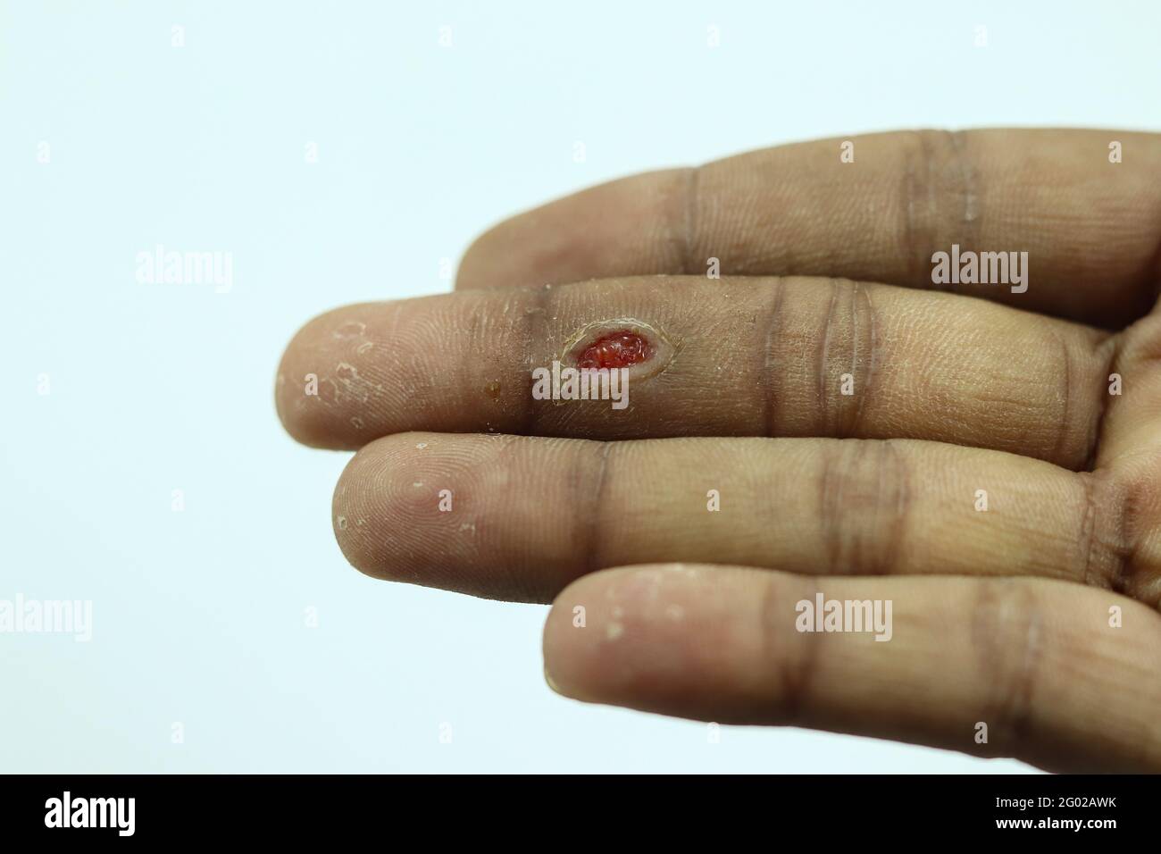 Closeup shot of a wound after removing a wart on a finger of a man ...