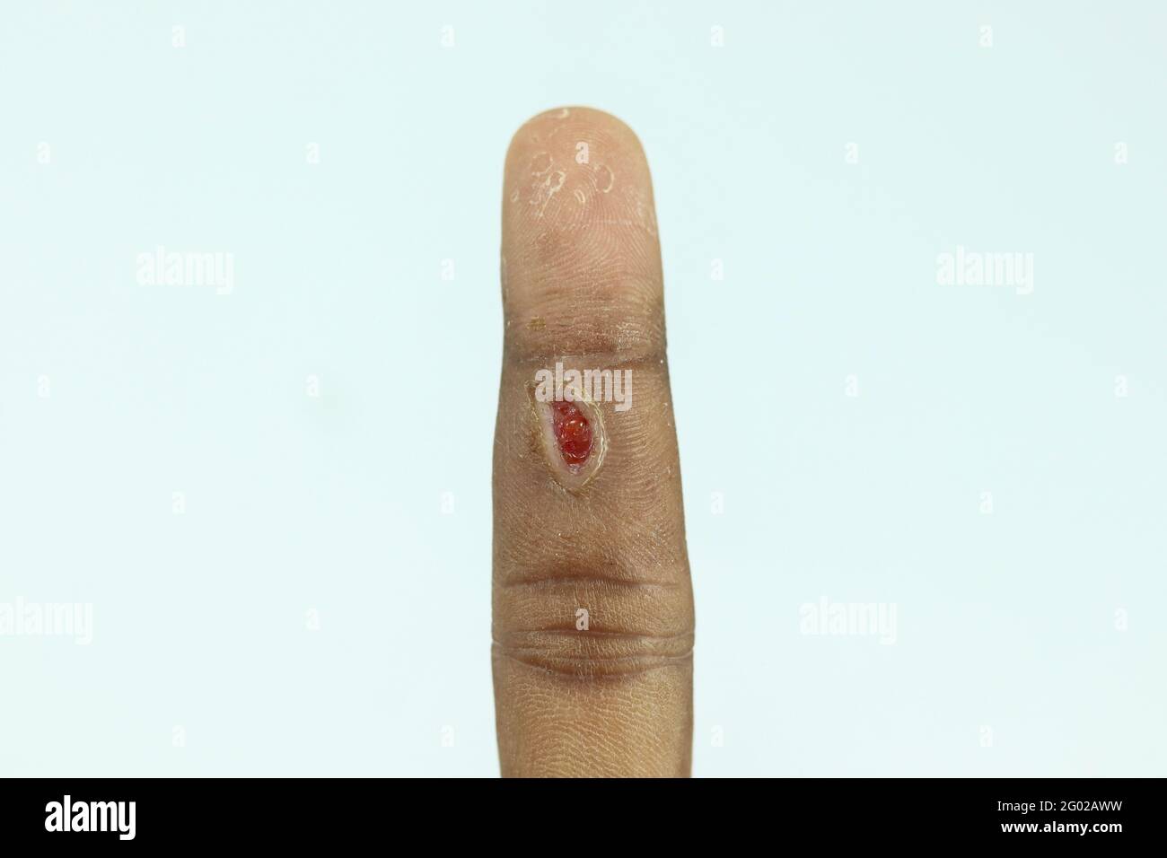 Closeup shot of a wound after removing a wart on a finger of a man ...