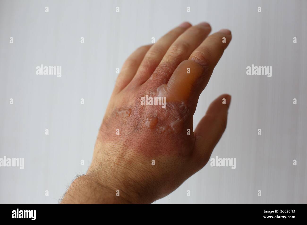 severe burn and blister on the hand, the palm burned with boiling water ...