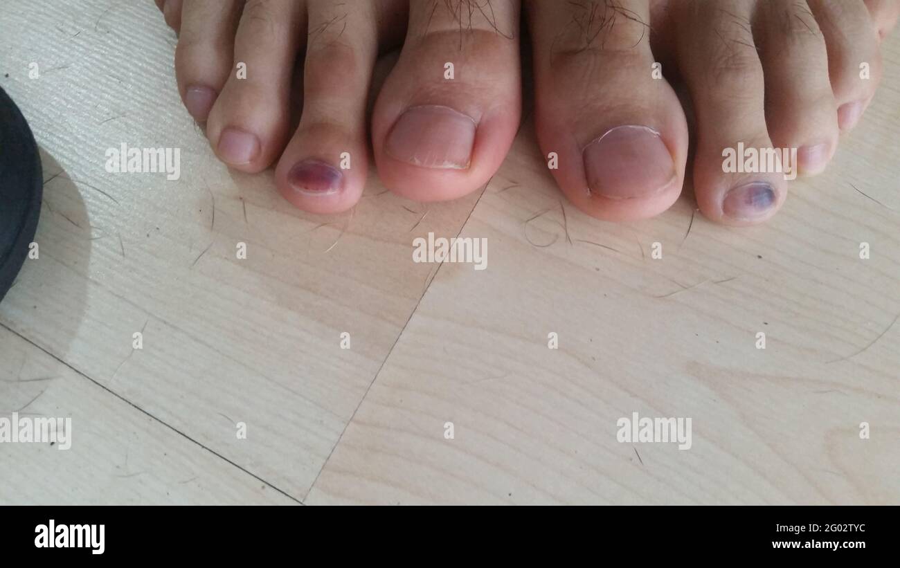Skin abrasion hi-res stock photography and images - Alamy