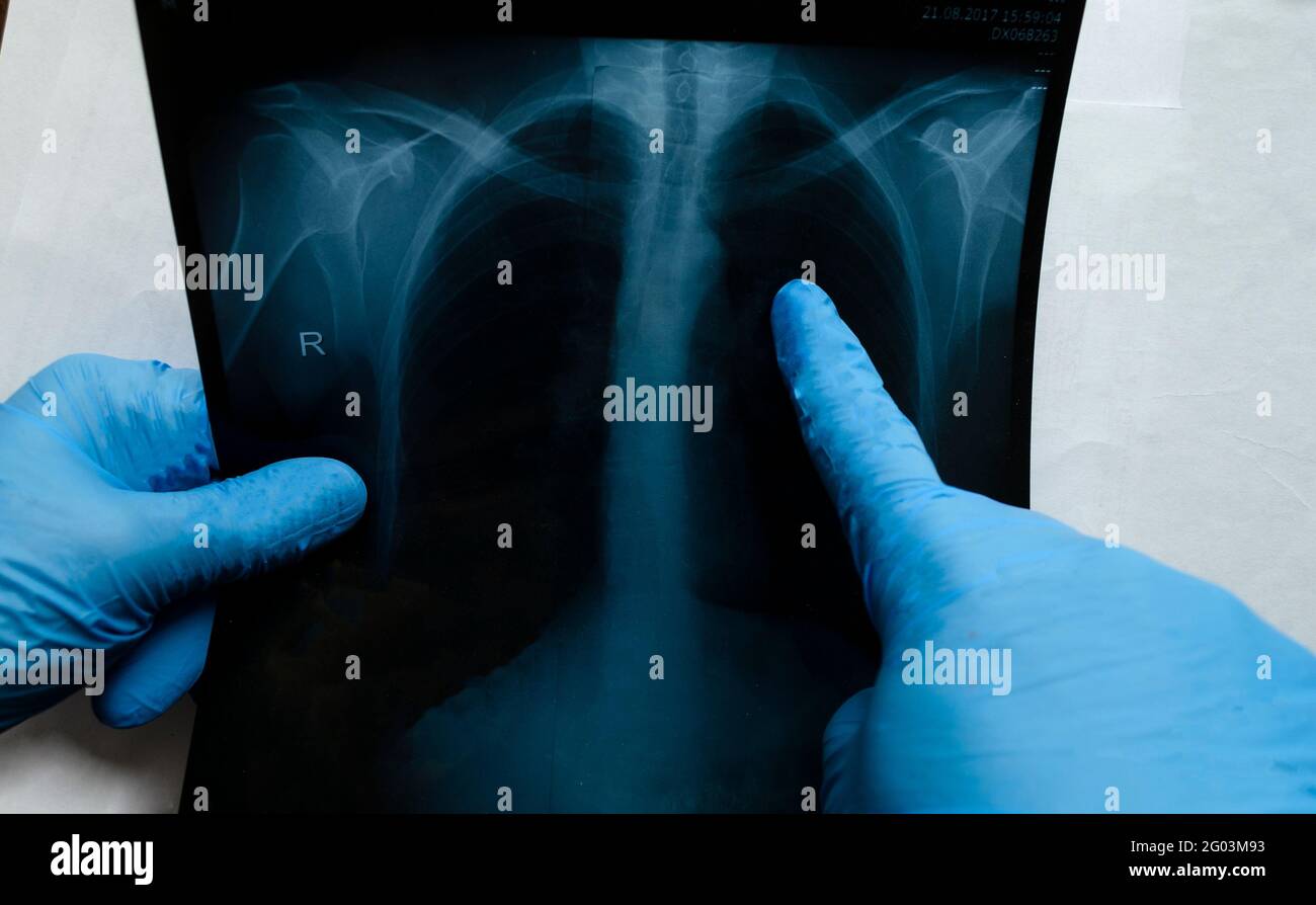 Lung damage hi-res stock photography and images - Alamy