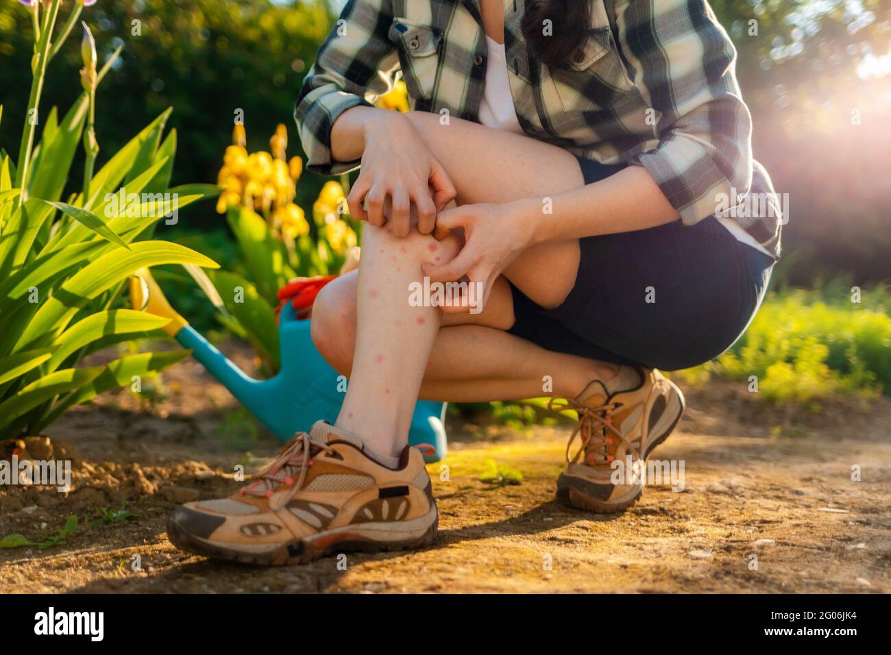 Allergies And Insect Bites Concept Person Scratches Her Legs Which Is