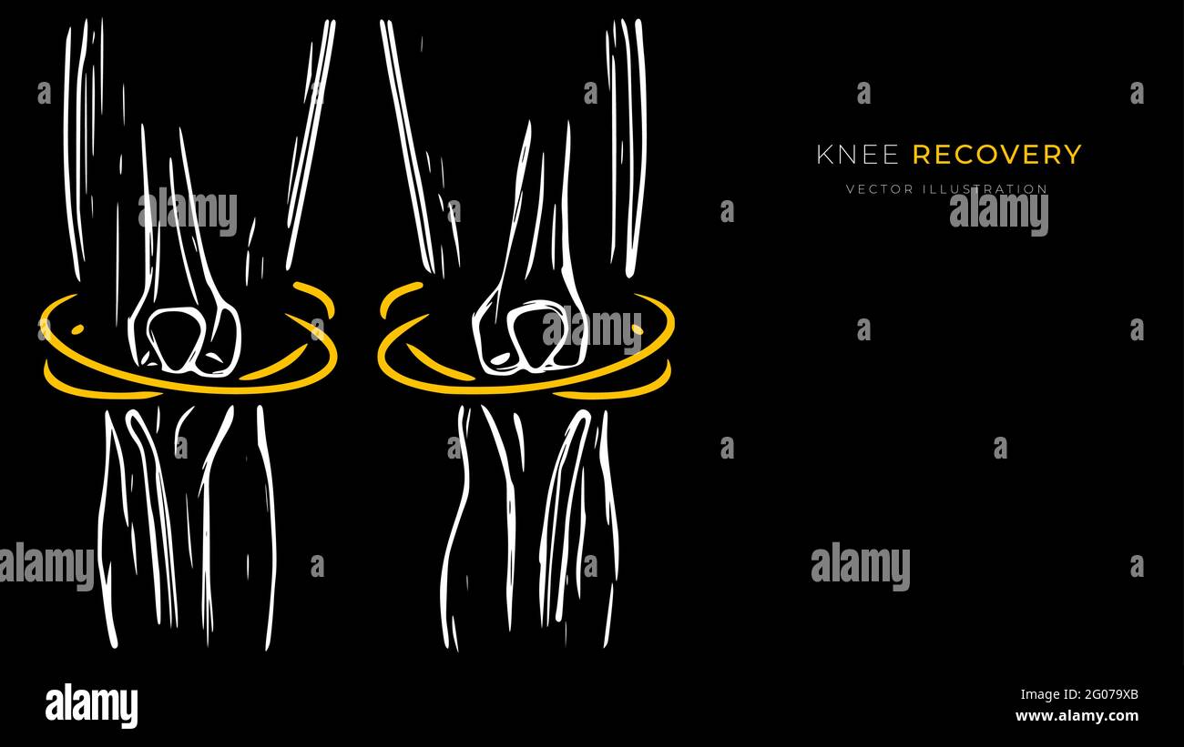 Vector illustration of knee recovery. Creative medical poster or banner ...