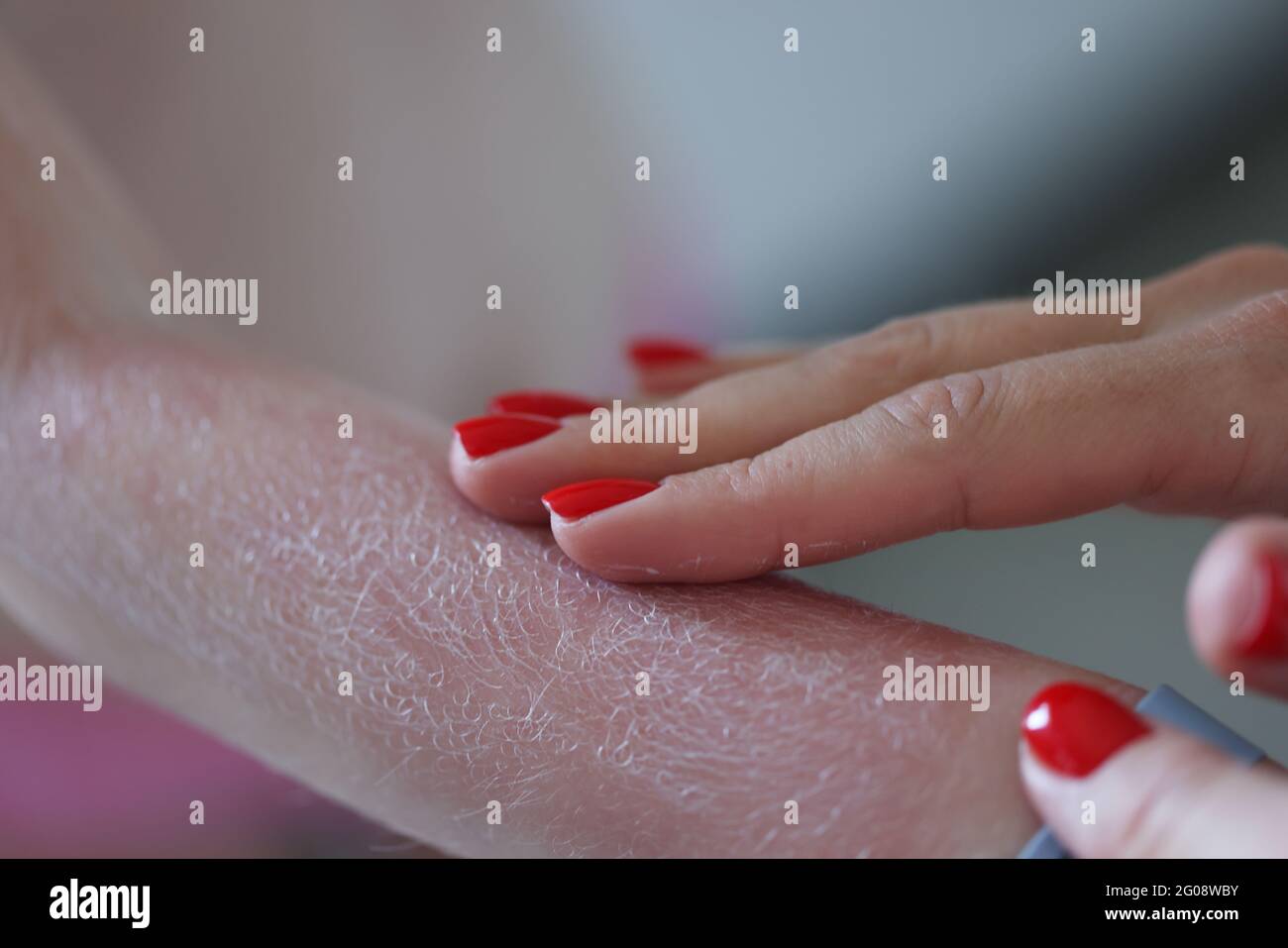 Child sunburn hi-res stock photography and images - Alamy