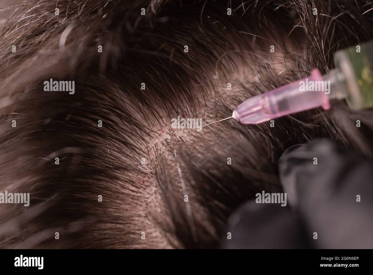 Mesotherapy session hi-res stock photography and images - Alamy