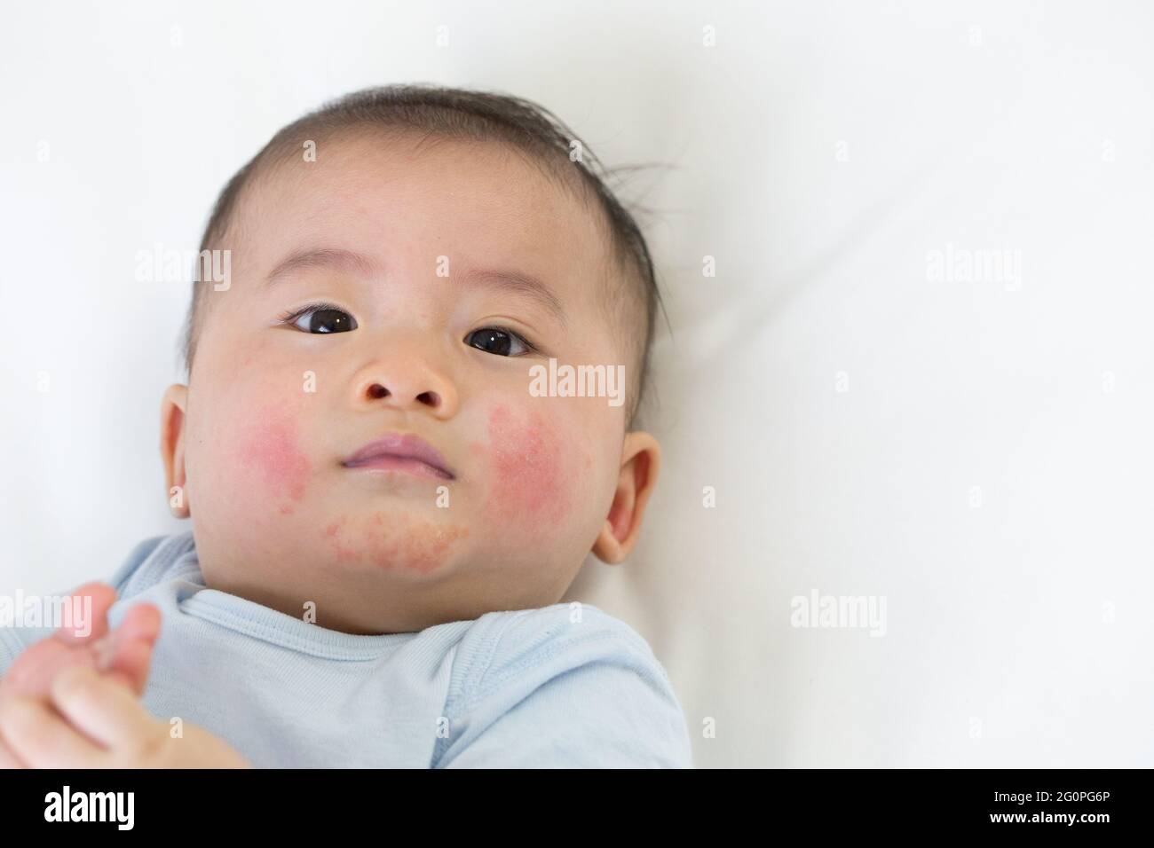Skin rashes in babies concept Stock Photo - Alamy