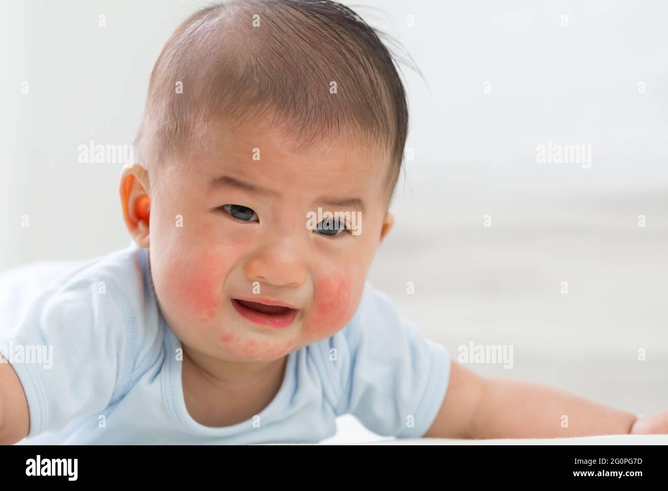 Skin rashes in babies concept Stock Photo - Alamy