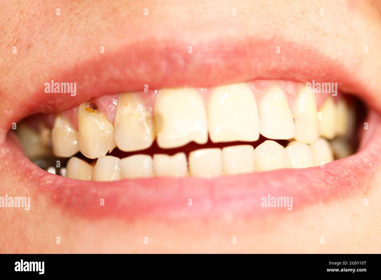 The tooth collapses after removing the braces, a hole in the tooth ...