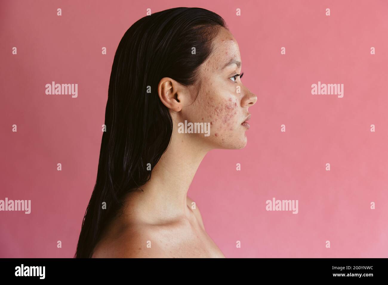 Side view close up of woman having acne on face. Portrait of sad ...