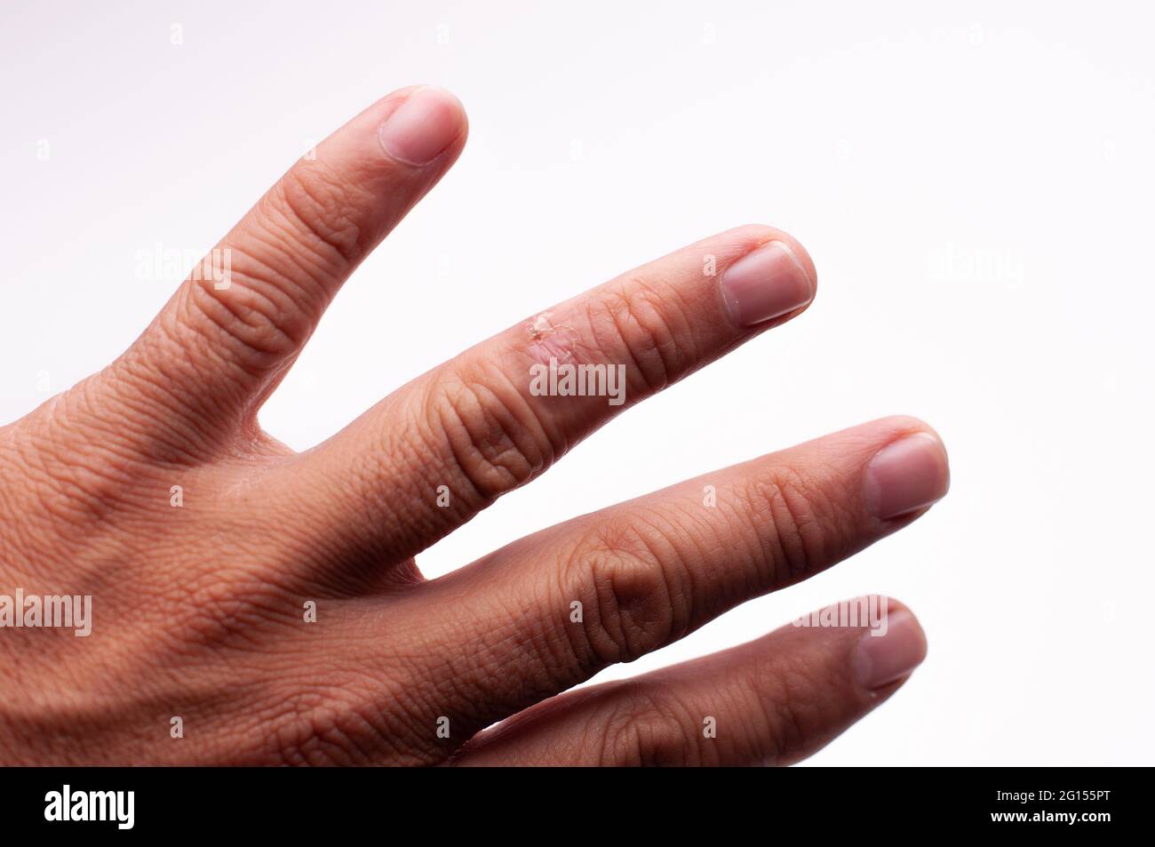 Plaque Psoriasis High Resolution Stock Photography and Images - Alamy