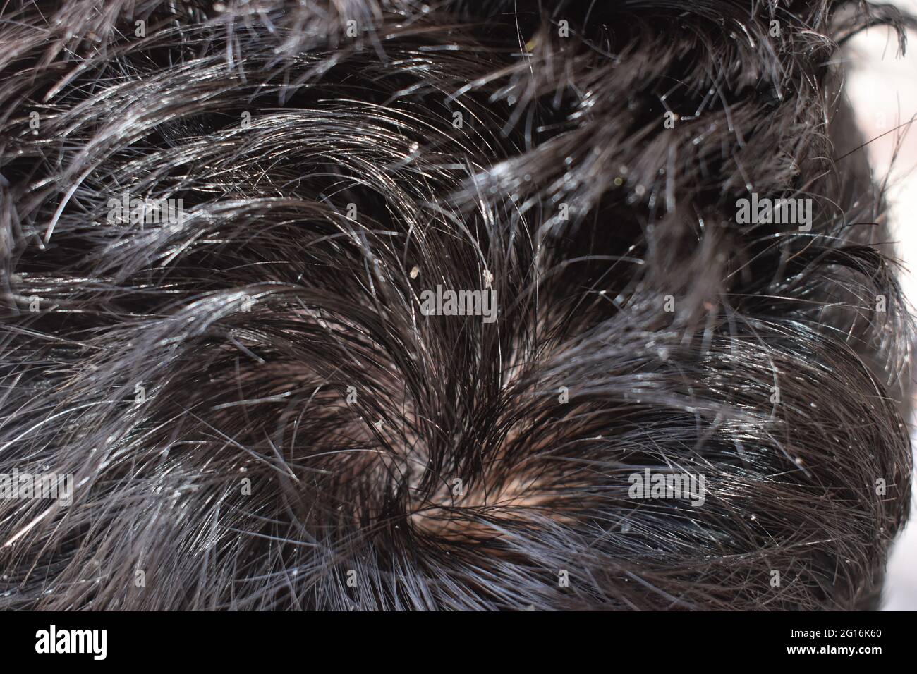 Men's hair is a top view close-up with Gray hair and Dandruff Stock ...