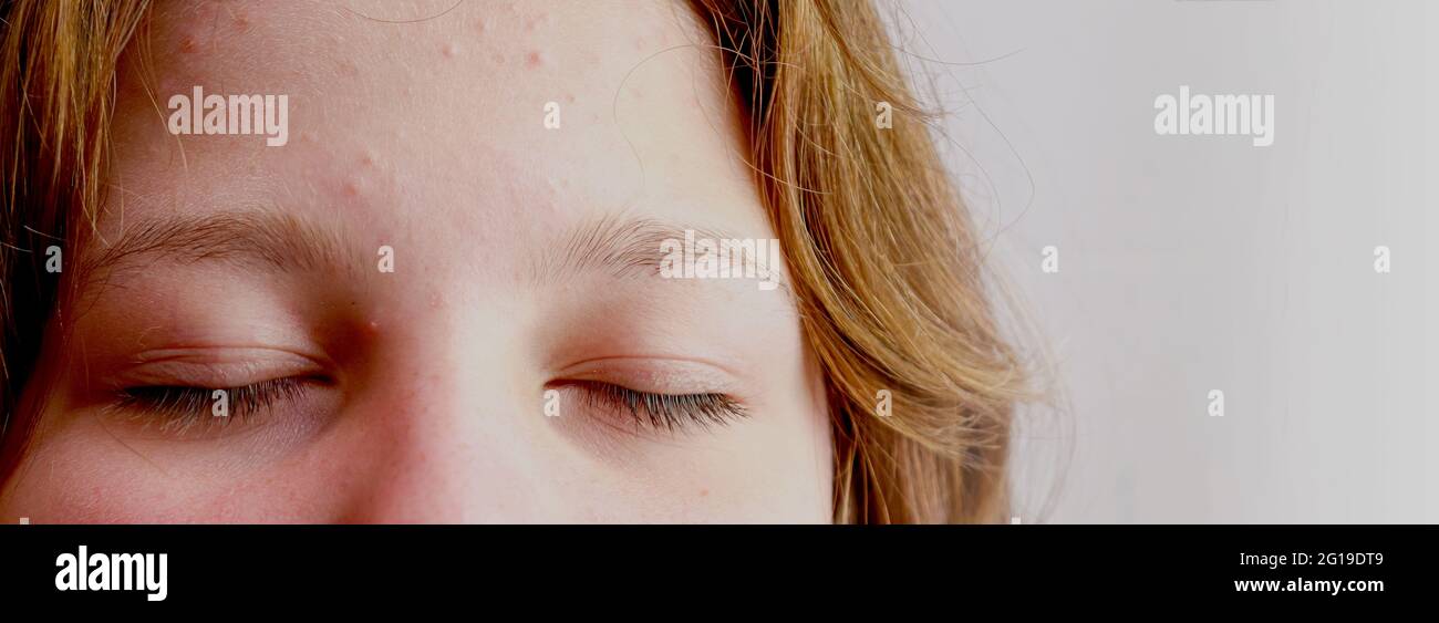 White spot on forehead hi-res stock photography and images - Alamy