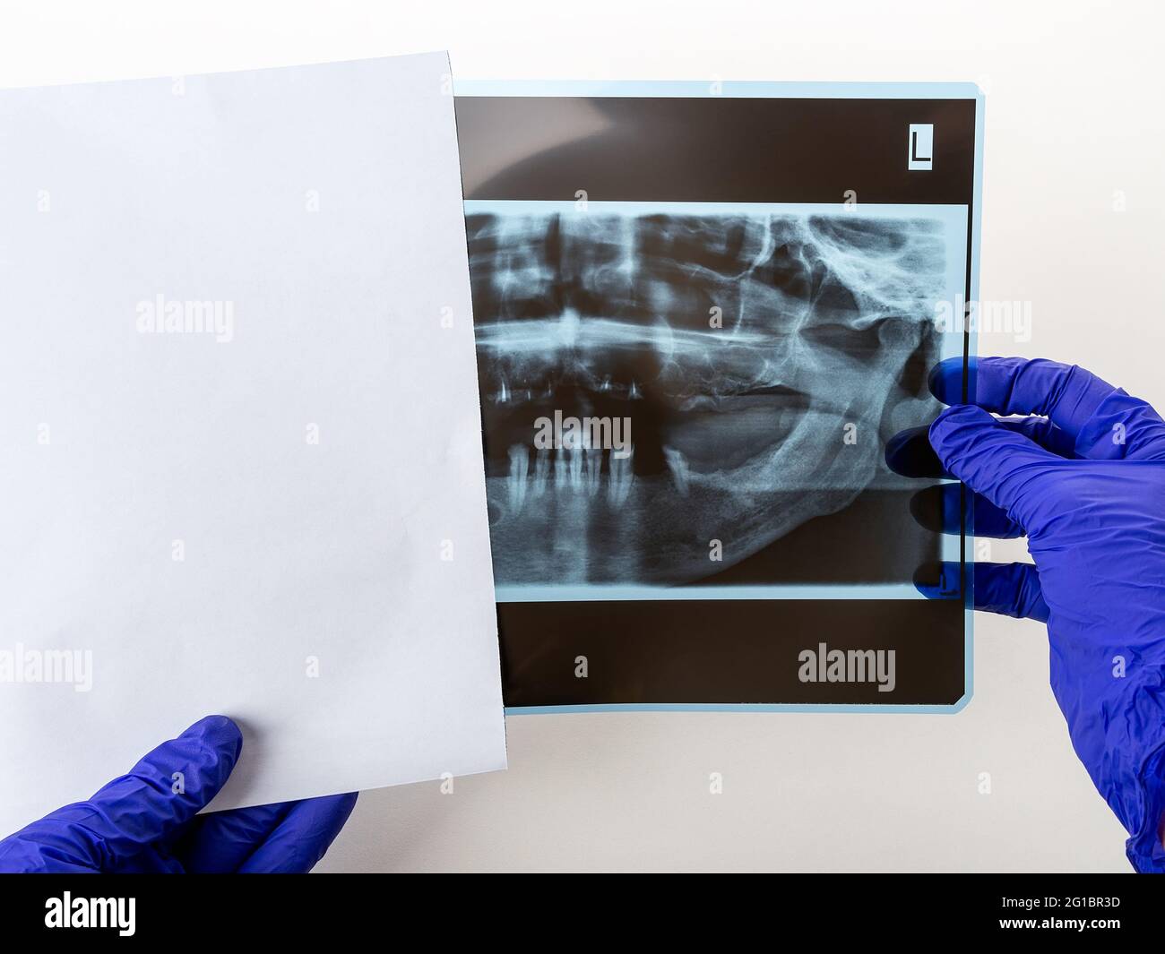 Dentist hands take the panoramic facial x-ray image out of the paper ...