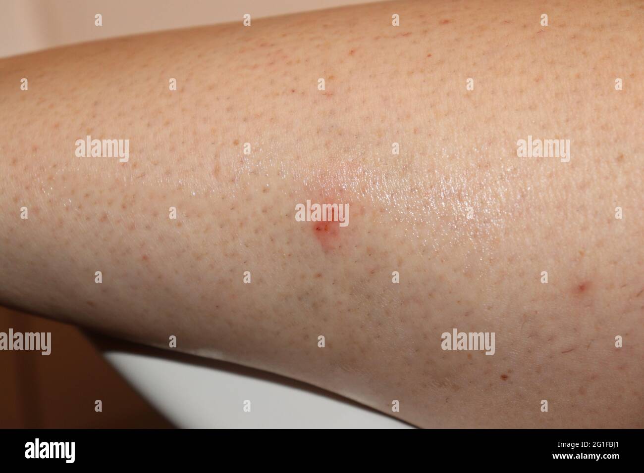 Snake bite on the back of a woman's leg Stock Photo - Alamy