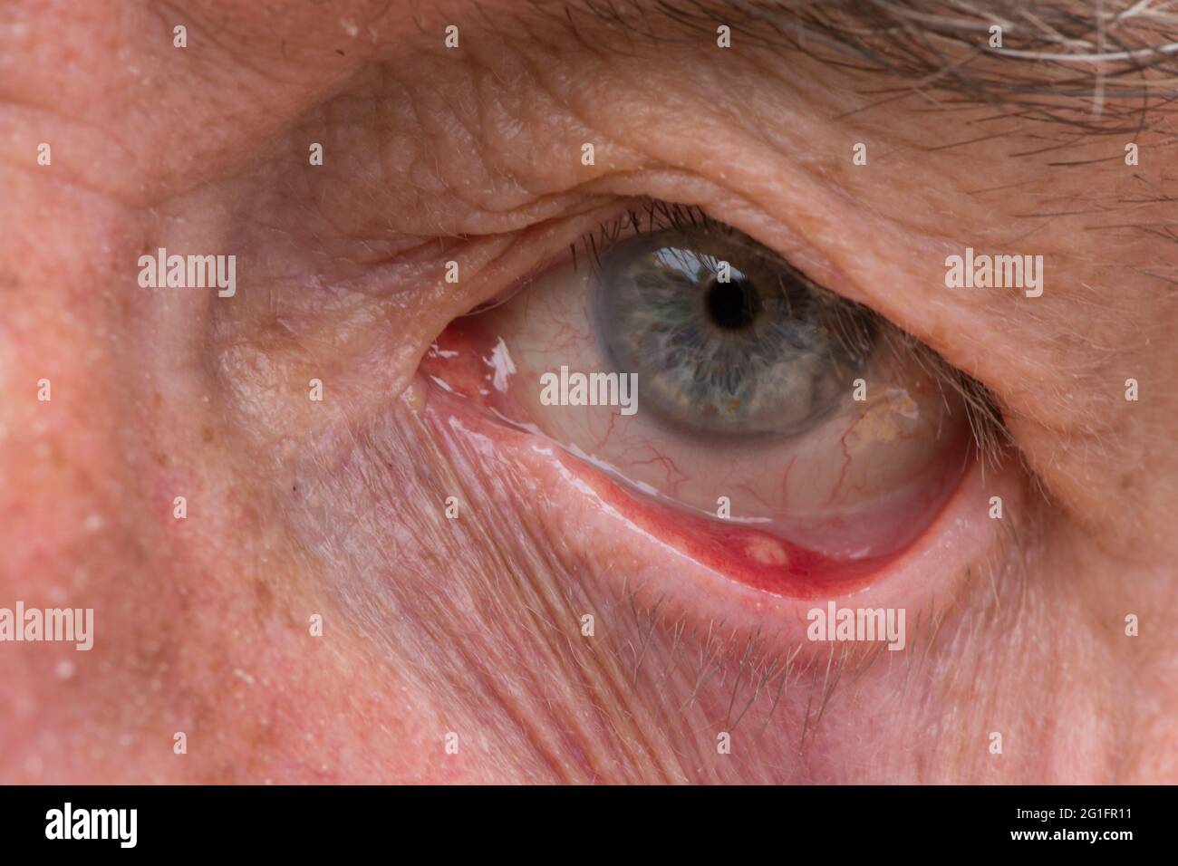 eye cyst which could become a stye, inside of lower lid Stock Photo - Alamy