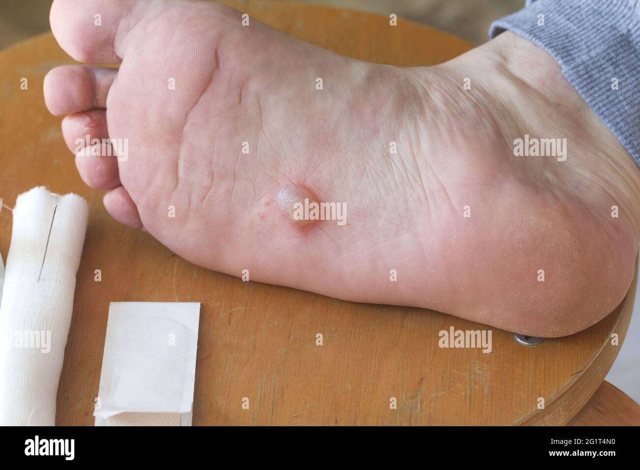 Eczema On Bottom Of Foot Shop