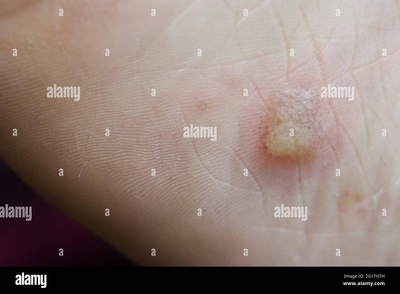 Dyshidrotic eczema on the foot. Blister dermatitis. Close-up shot Stock ...