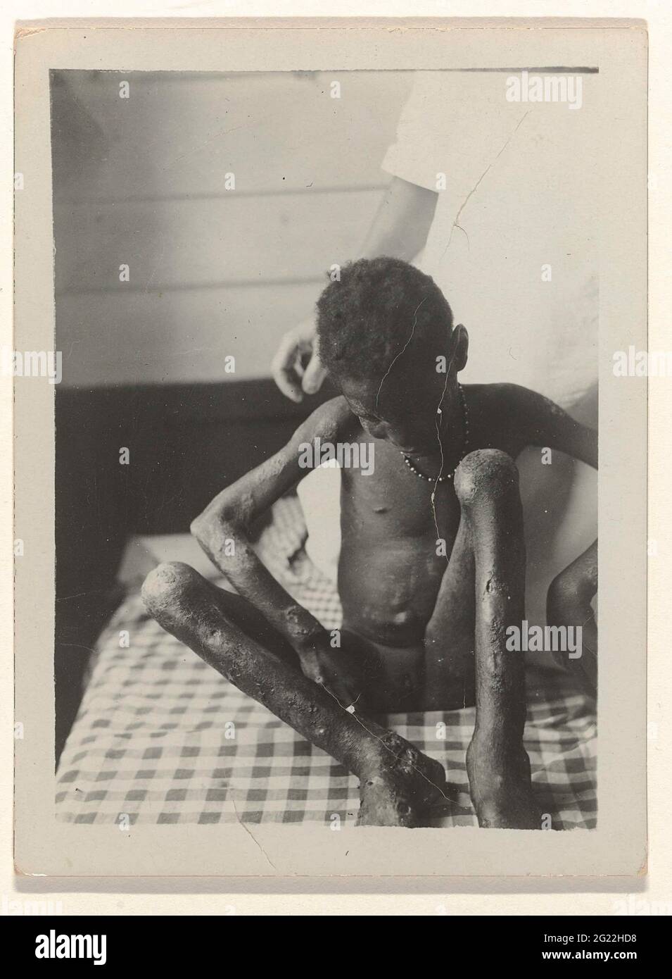 Girl with leprosy Stock Photo - Alamy