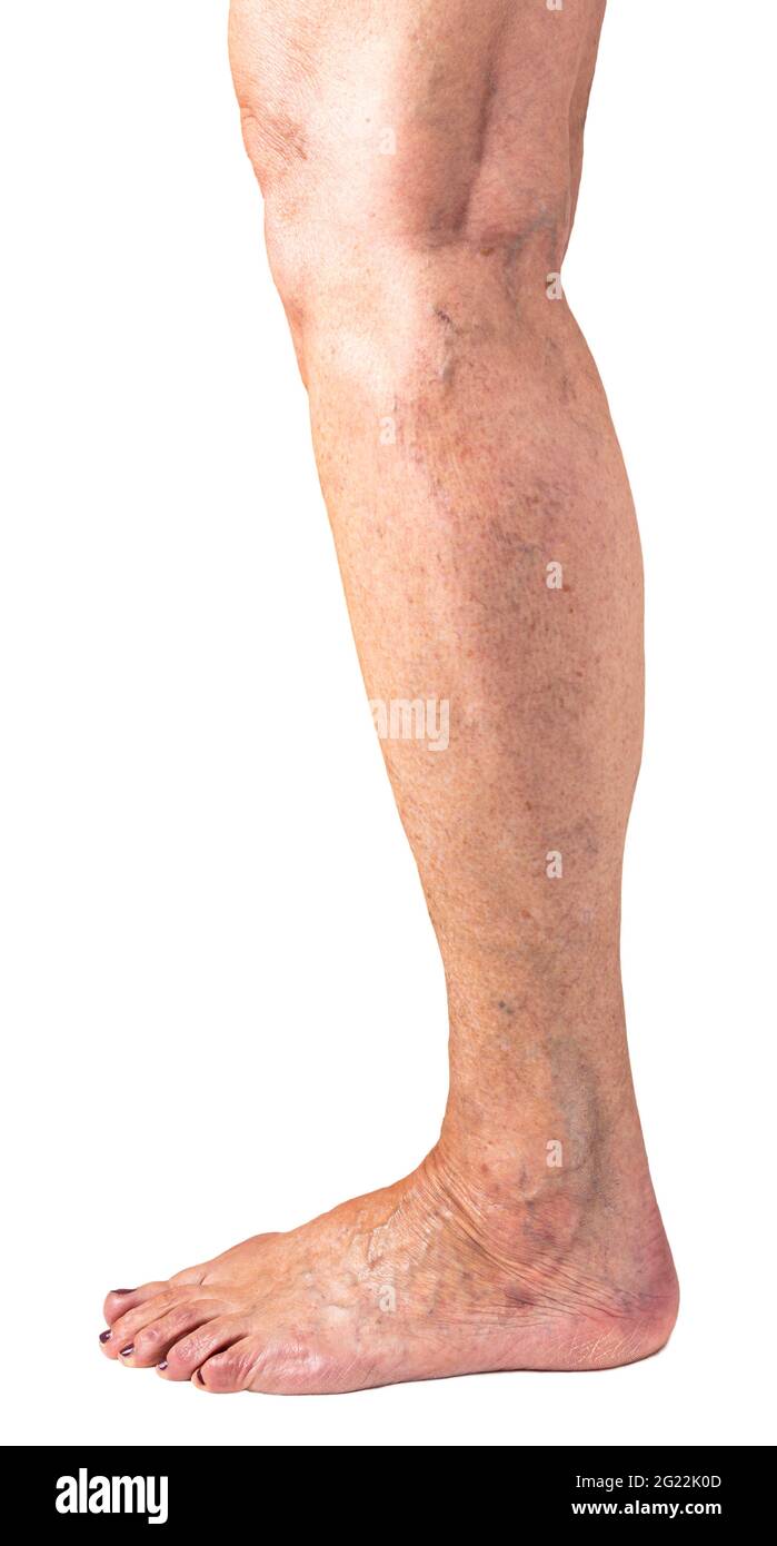 Spider Veins On Legs