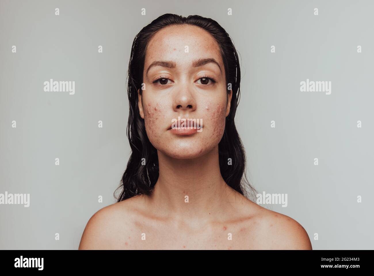 Close up of woman with acne inflammation on grey background. Portrait ...