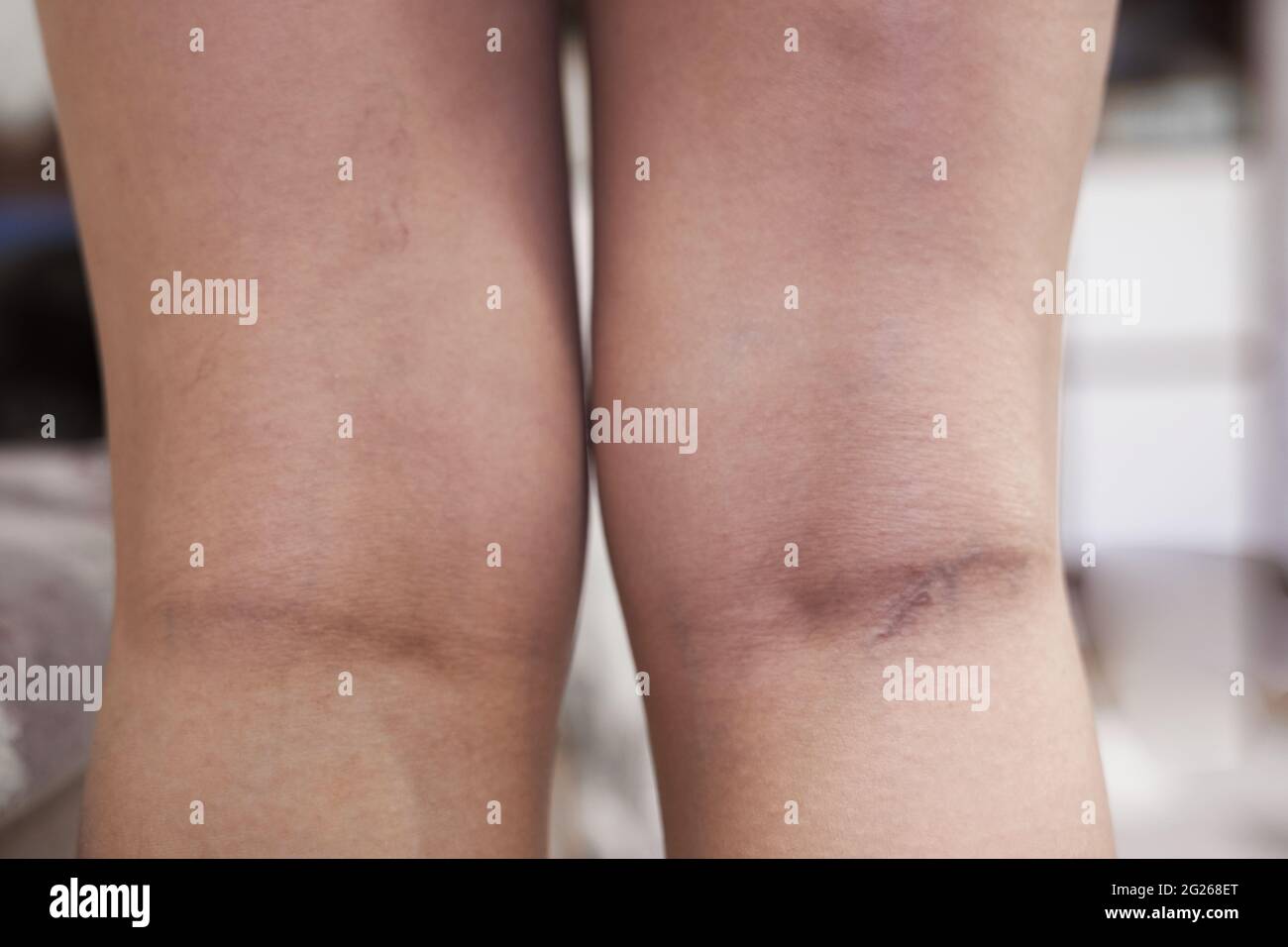 Varicose veins in legs hi-res stock photography and images - Alamy