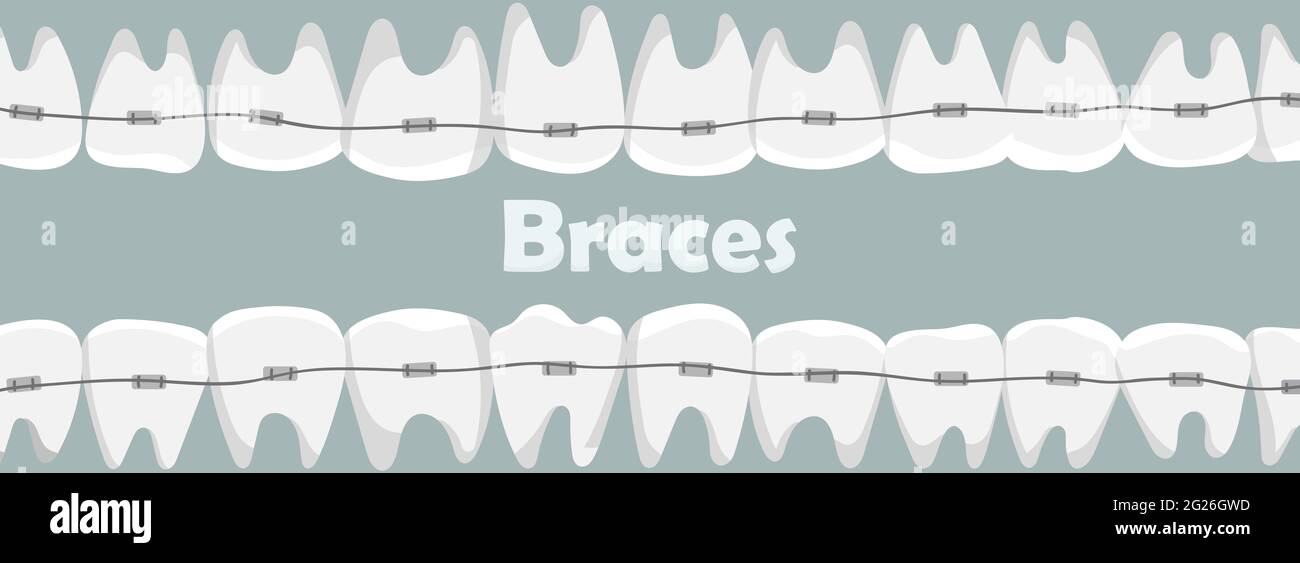 Dental braces poster hi-res stock photography and images - Alamy