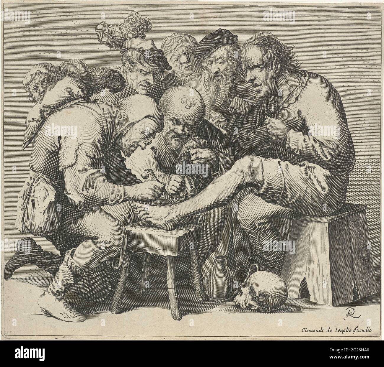 Foot operation. A surgeon performs surgery at the foot of a man in the ...