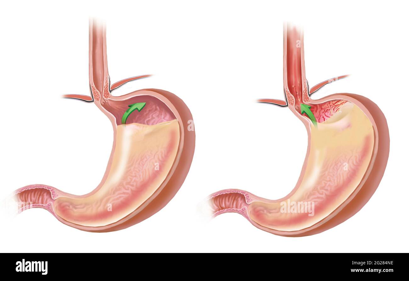 Normal closed pyloric valve and leaky valve with GERD Stock Photo - Alamy