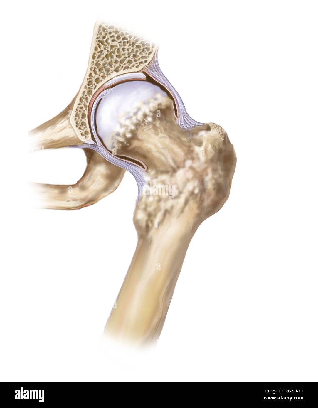 Detail of hip joint showing osteoarthritis Stock Photo - Alamy