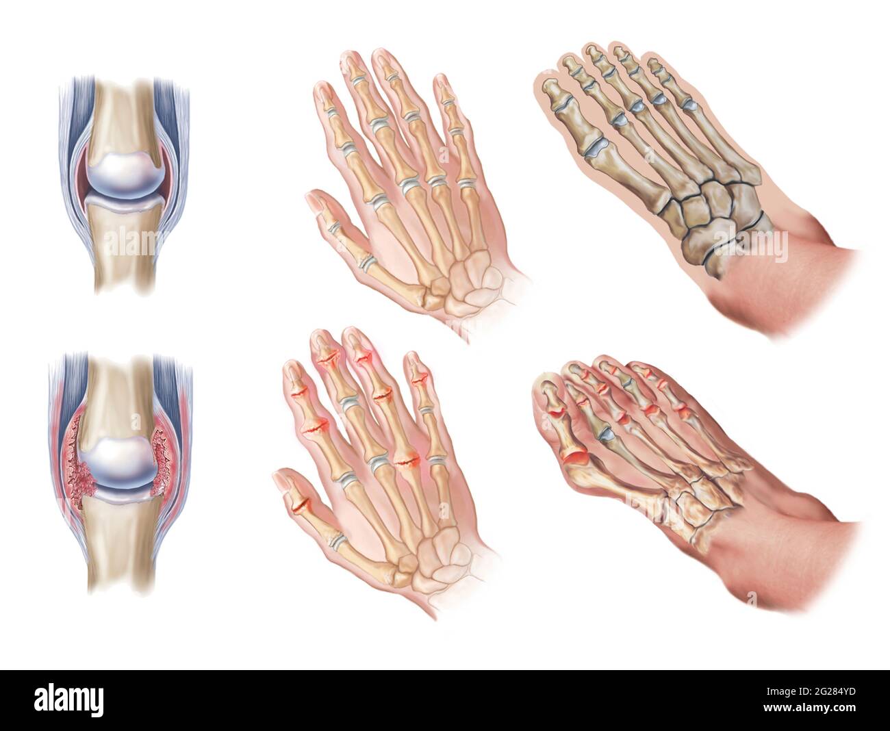Psoriatic arthritis feet Cut Out Stock Images & Pictures - Alamy Psoriatic arthritis feet Cut Out Stock Images & Pictures - Alamy