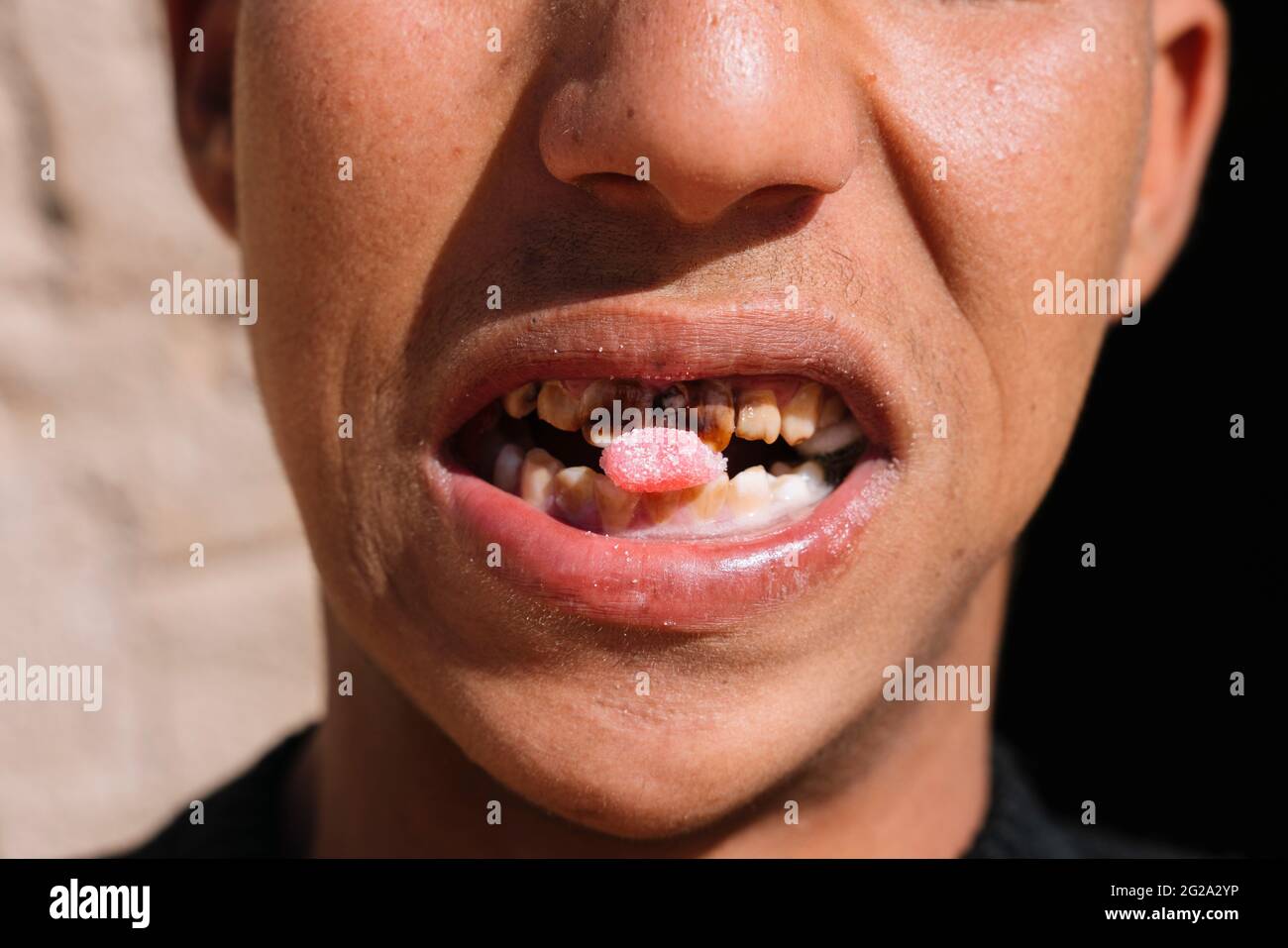 Decayed teeth hi-res stock photography and images - Alamy