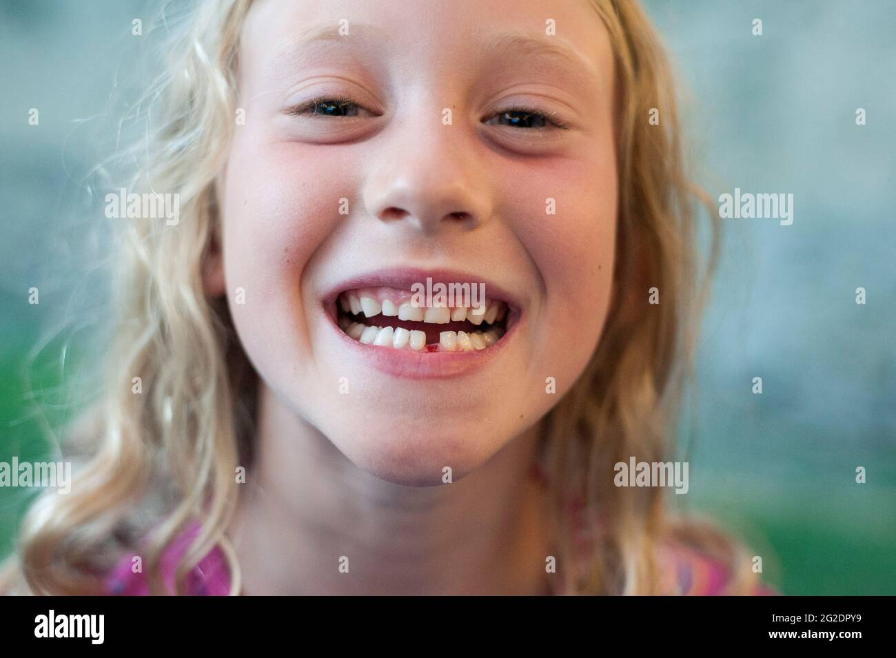 A young girl has her first tooth pulled out by her mother Stock Photo ...