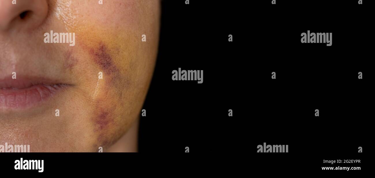 Unrecognizable woman face with bruises against black background Stock ...