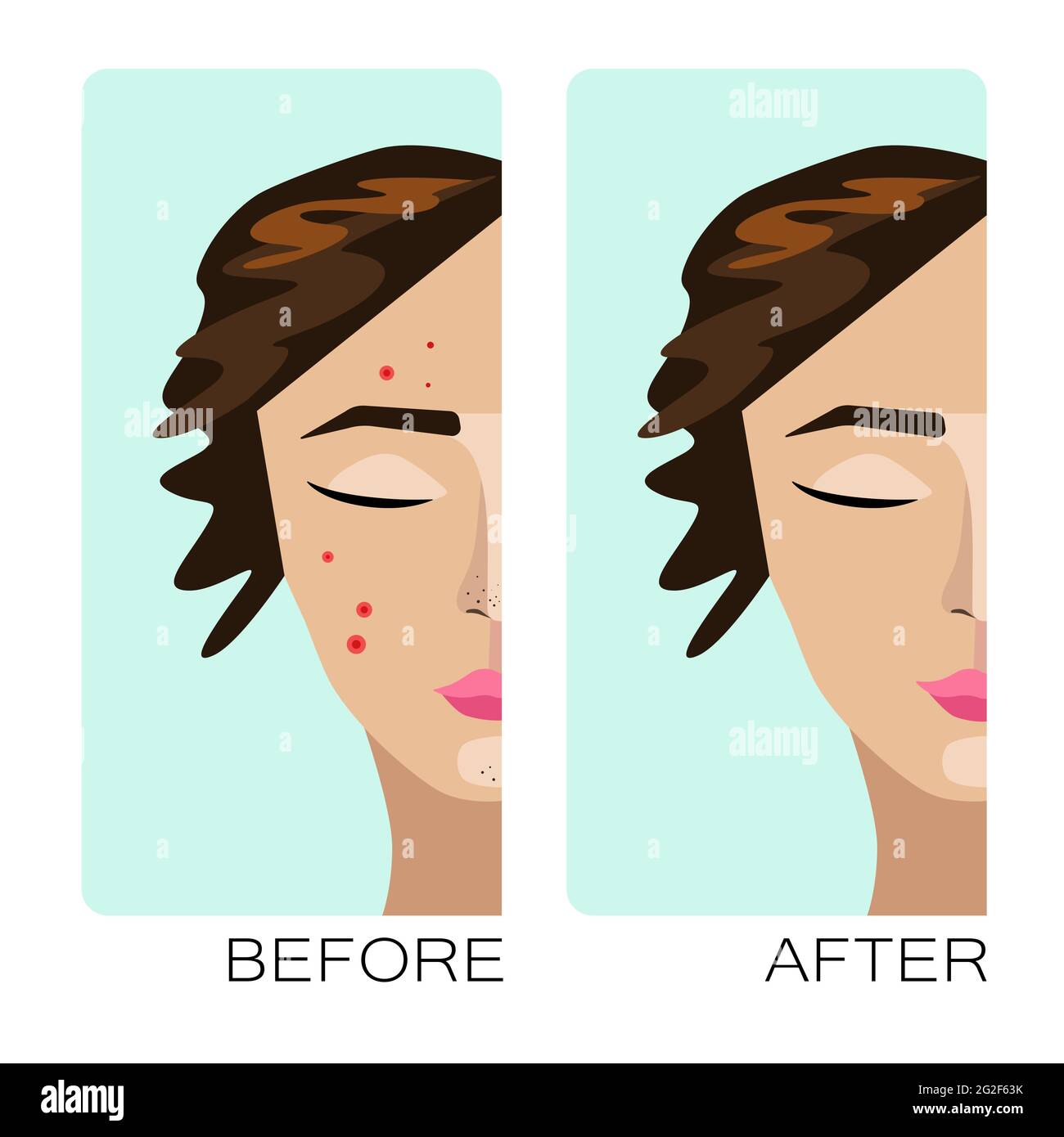 Woman face with acne problems, pimples, blemish skin, hormones ...